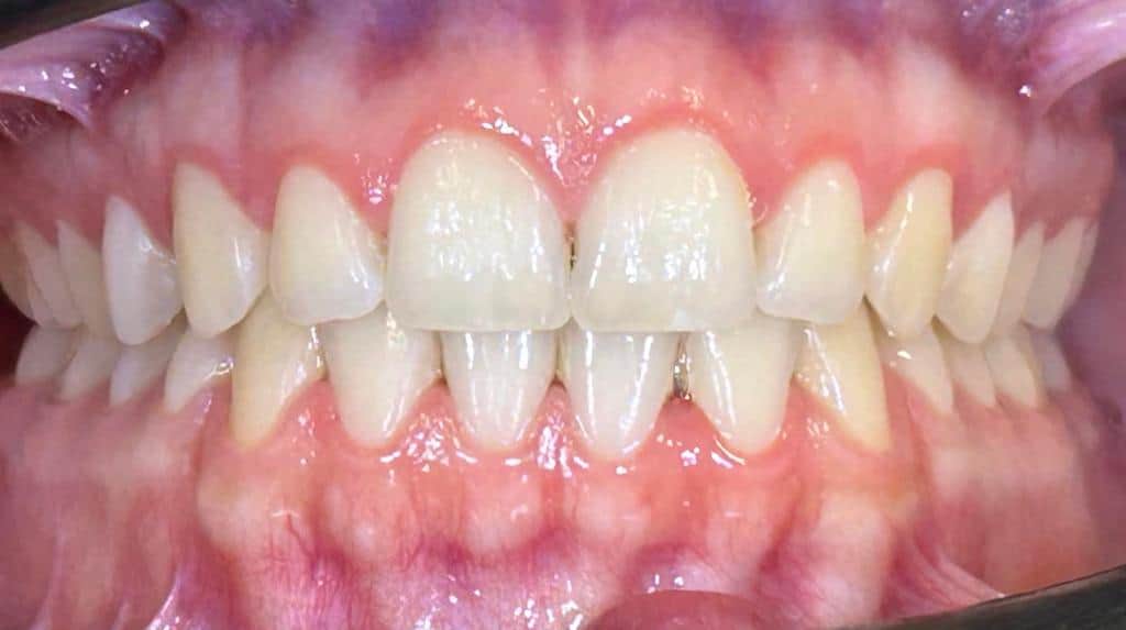 Plástica Gengival - Um Sorriso Harmonioso, Bonito e Saudável - Clínica Line